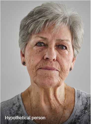 Who May Benefit from TAVNEOS® (avacopan)?